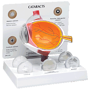 Cataract Eye Model